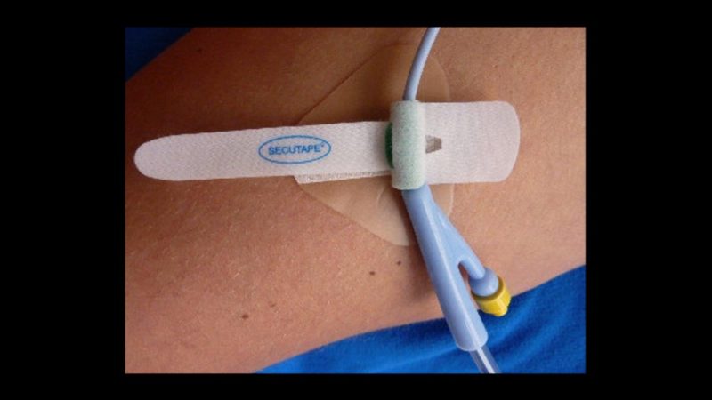 SECUTAPE® kateter fiksering - adCARE AS