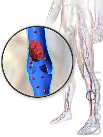 Webinar: DVT Scanning i allmennpraksis – Onsdag 2. september 2020, kl ...